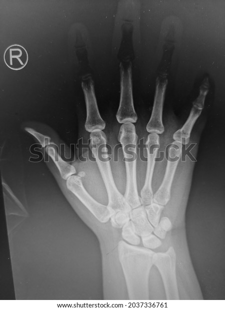 Plain Xray Right Hand Normal Radiographic Stock Photo 2037336761 ...