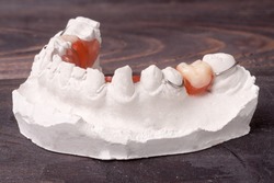 Plaster cast of teeth with removable featuring dental, plastic, and ...