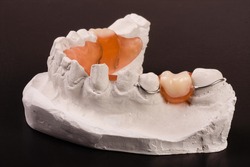 Plaster cast of teeth with removable featuring dental, plastic, and ...