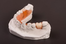Plaster cast of teeth with removable featuring dental, plastic, and ...