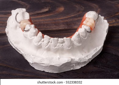 Plaster Cast Teeth Removable Partial Denture Foto Stok 578295361 ...