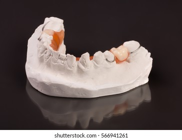 Стоковая фотография 538902805: Plaster Cast Teeth Removable Partial ...