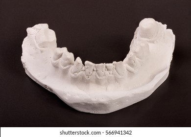 Plaster Cast Teeth Removable Partial Denture Stock Photo (Edit Now ...