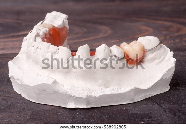 Стоковая фотография 538902805: Plaster Cast Teeth Removable Partial ...