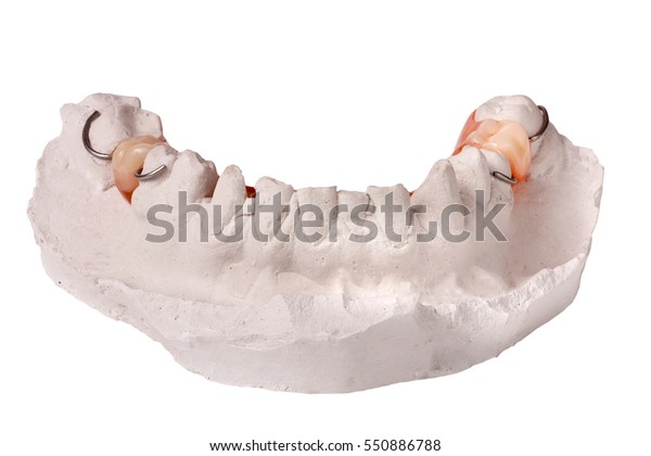 Plaster Cast Teeth Removable Partial Denture Stock Photo 550886788 ...