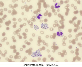 162 Platelet clumping Images, Stock Photos & Vectors | Shutterstock