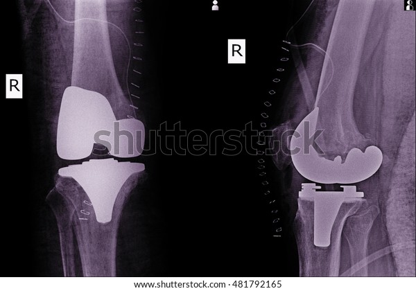 Post Operation Cemented Total Knee Replacement Stock Photo (Edit Now ...