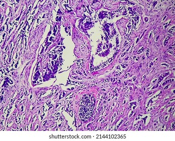 Prostate Cancerturp Microscopic Image Prostatic Tissue Stock Photo ...