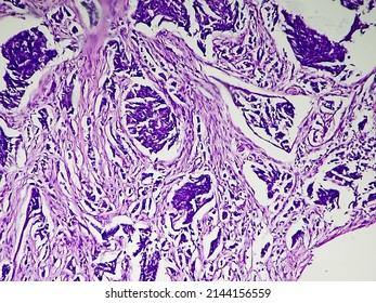 Malignant neoplasm Images, Stock Photos & Vectors | Shutterstock