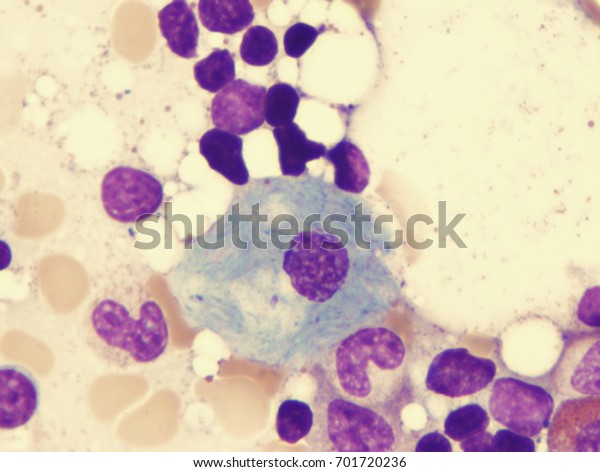 3 Gaucher Cells Images, Stock Photos & Vectors | Shutterstock