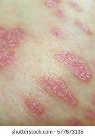 1,655 Psoriasis plaque Images, Stock Photos & Vectors | Shutterstock