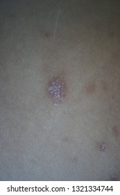 116 Plaque psoriasis scale Images, Stock Photos & Vectors | Shutterstock