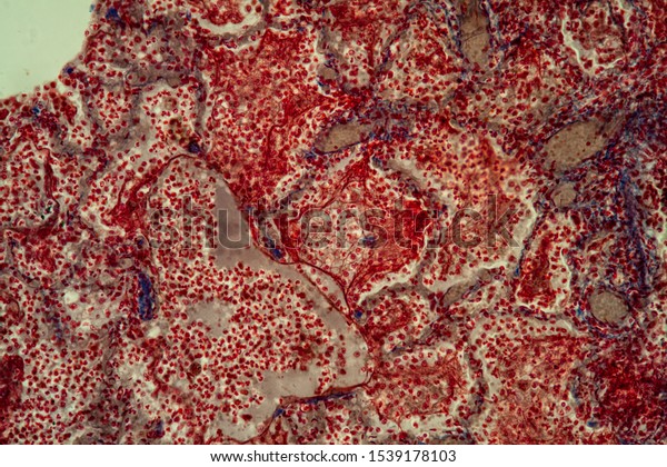 Pulmonary Tuberculosis Tissue Under Microscope 200x Stock Photo ...