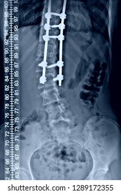 Radiography Deviation Spine Stock Photo (Edit Now) 1289172355
