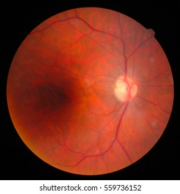 Retinal Stock Photo 559736152 | Shutterstock