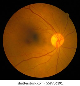 Retinal Stock Photo 559736191 | Shutterstock