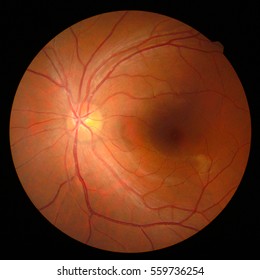 Retinal Stock Photo 559736254 | Shutterstock