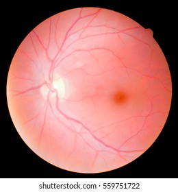 1,842 Macula of retina Images, Stock Photos & Vectors | Shutterstock