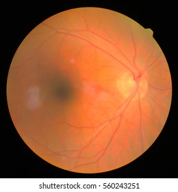 Medical Image Ocular Fundus Human Retina Stock Photo (Edit Now) 1126908689