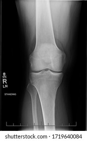 Xray Radiograph Human Knee Showing Ballottement Stock Photo (Edit Now ...