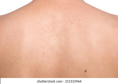 Closeup Skin Problem Polyps On Neck 스톡 사진 1976346791 | Shutterstock