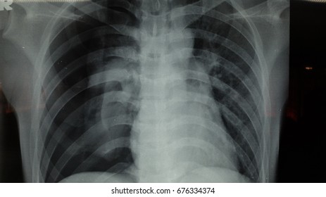 Pneumothorax Images, Stock Photos & Vectors | Shutterstock