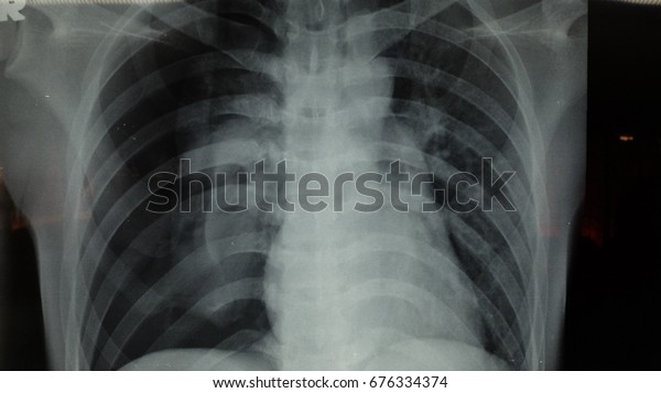 Rt Lung Pneumothorax Collapse Segment On Stock Photo 676334374 ...