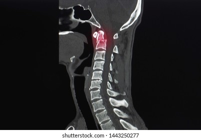 Sagittal View Computer Tomography Ct Scan: стоковая фотография ...