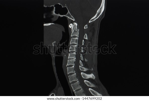 Sagittal View Computer Tomography Ct Scan Stock Photo (Edit Now) 1447699202