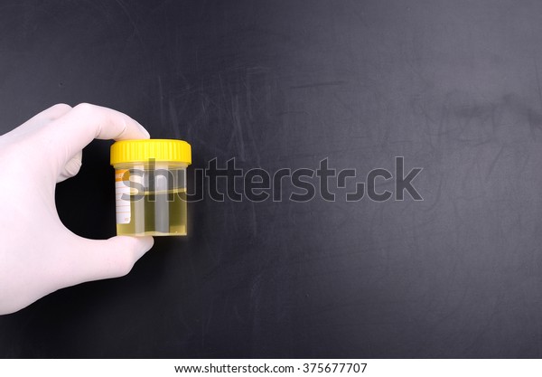 Sample Urine Small Container Stock Photo 375677707 | Shutterstock