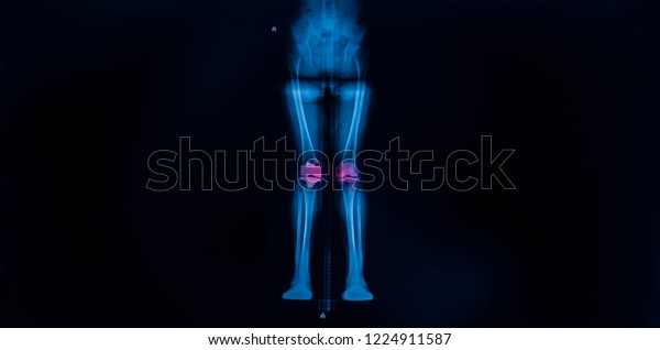 Scanogram/orthoroentgenogram shown lower limb alignment in patient with ...