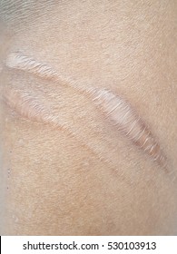 Scars Stock Photo 530103913 | Shutterstock