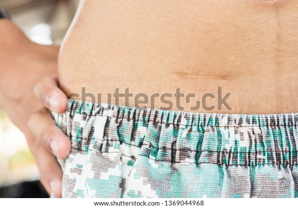 Scars After Surgery Appendicitis Stock Photo 1369044968 | Shutterstock