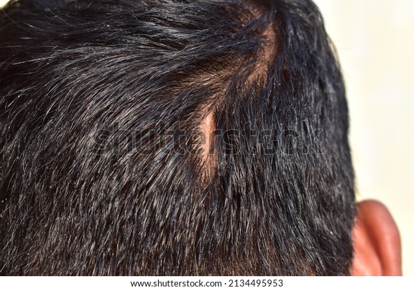 8,957 Scar On The Head Images, Stock Photos & Vectors | Shutterstock