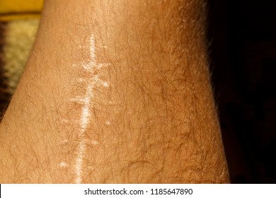 Pacemaker scar : 156 images, photos et images vectorielles de stock ...