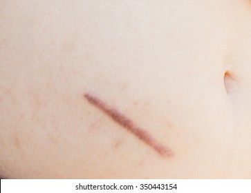 6,417 Surgical scar Images, Stock Photos & Vectors | Shutterstock