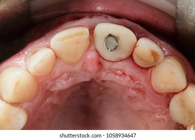 Healing Abutment After Implantation Addition Soft Stock Photo (Edit Now ...