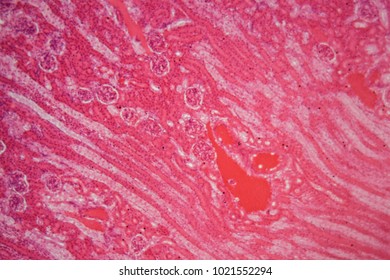 Стоковая фотография 1596726763: Photomicrograph Skin Biopsy Showing ...