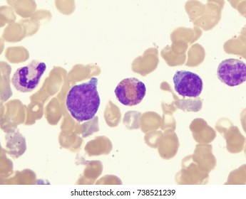 Acute Myelocytic Leukemia Aml M2 Eosinophilic Foto stock 738714022 ...
