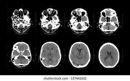 Set Imaging Computed Tomography Ct Head Stock Photo 137442632 ...
