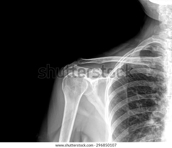 Shoulder Xrays Image Stock Photo (Edit Now) 296850107