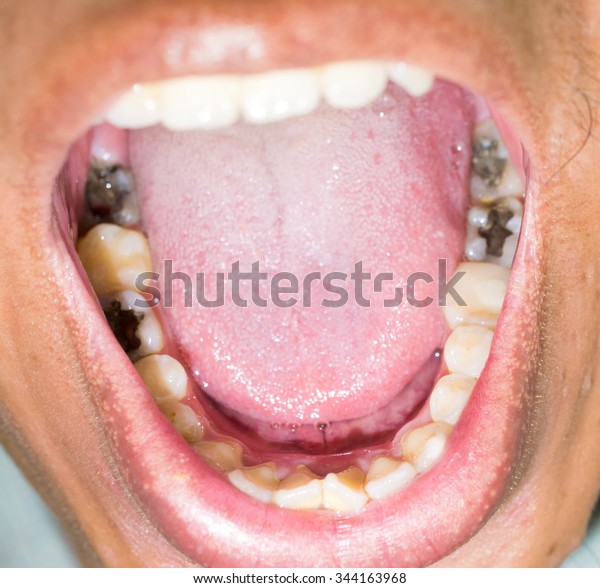 Simple Cavity Between Healthy Teeth Mouth Stock Photo 344163968 ...