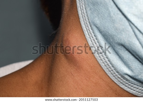 Single Swelling Lymph Node Neck Asian Stock Photo (Edit Now) 2051127503