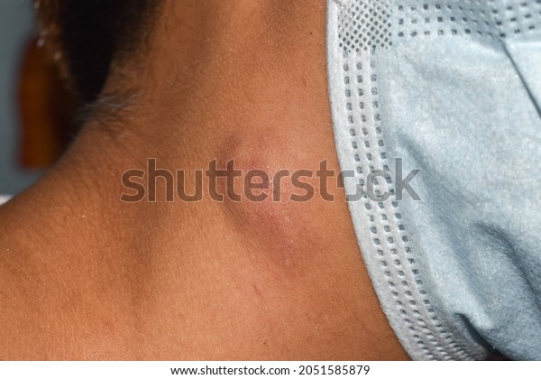 Single Swelling Lymph Node Neck Asian Stock Photo 2051585879 | Shutterstock