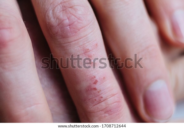 Skin Diseases Derma Infection Eczema Psoriasis Stock Photo (Edit Now ... Skin Diseases Derma Infection Eczema Psoriasis Stock Photo (Edit Now ...