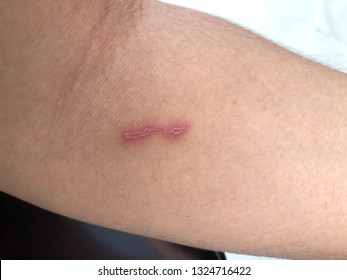 Paederus dermatitis : 116 images, photos et images vectorielles de ...