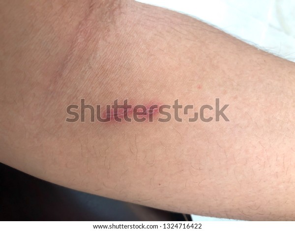 Small Linear Initial Paederus Dermatitis On Stock Photo 1324716422 ...