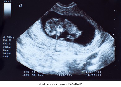Fetus 4months Womb Hand Head Visible Stock Photo (Edit Now) 15825496
