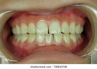 Treatment Malocclusion Before After Stock Photo 385788928 | Shutterstock