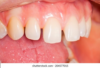 135,677 Teeth spacing Images, Stock Photos & Vectors | Shutterstock